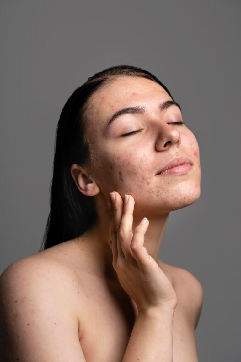 Acne Treatments in NYC: Your Complete Guide to Clear Skin - Derm Artisan